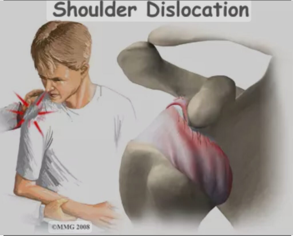 SHOULDER DISLOCATION : Dislocation of shoulder joint - Physio Heal Well