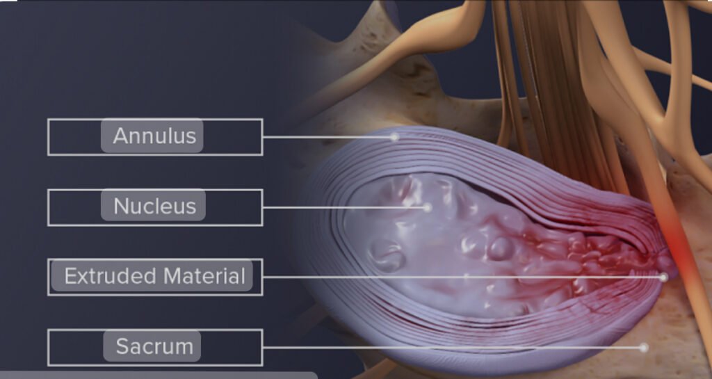 PIVD: Prolapsed Intervertebral Disc - Physio Heal Well