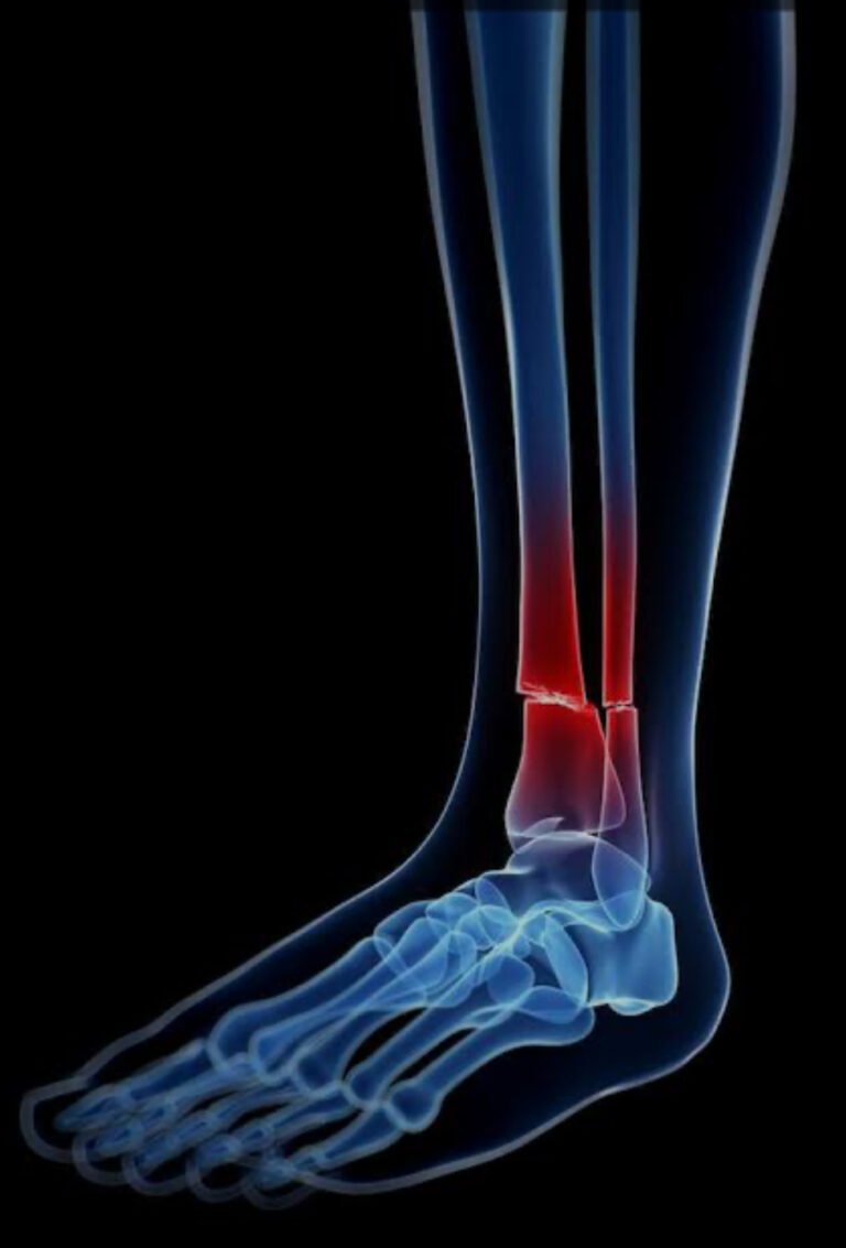 Fractures and its physiotherapy treatment - Physio Heal Well
